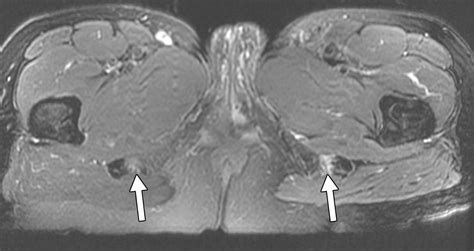 Pulled Hamstring Mri At Amy Yates Blog