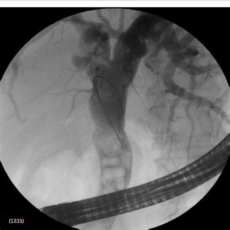 A Cholangiogram Showing Mildly Dilated CBD Studded With Multiple Stones Download Scientific