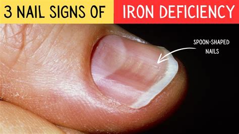 3 Nail Signs Of Iron Deficiency Anemia Youtube