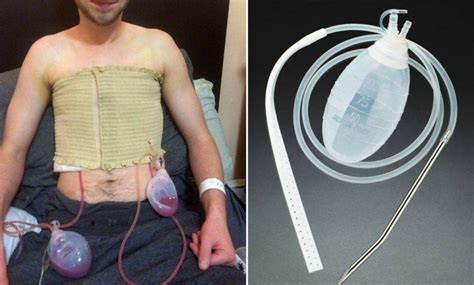 Jackson Pratt Drain Jp Afvoer Wat Is De Procedure Oorzaken Contra