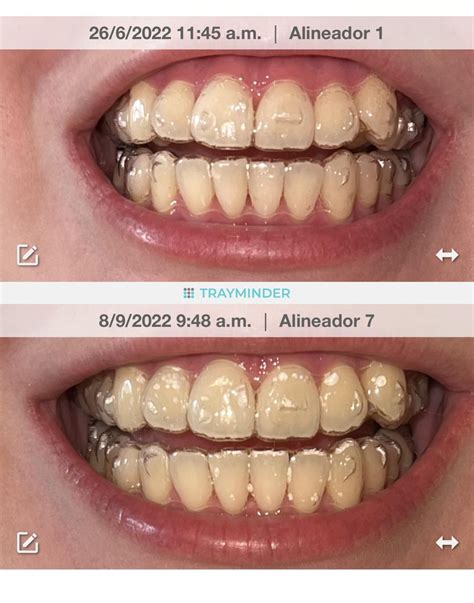 Before And After W Composite Bonding Keep At It Folks Dreams Do Come True R Invisalign