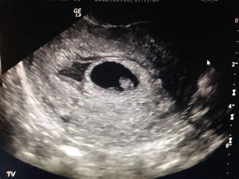 Subchorionic Hemorrhage Sonography Ultrasound Diagnostic Medical Sonography