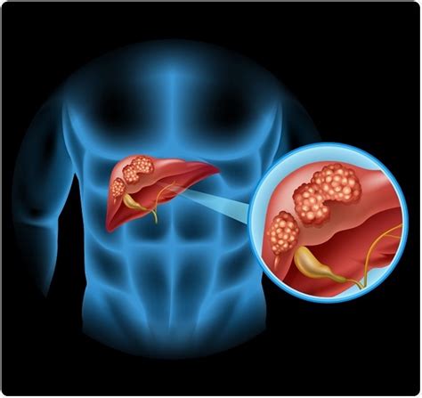 What Causes Bile Duct Cancer Symptoms