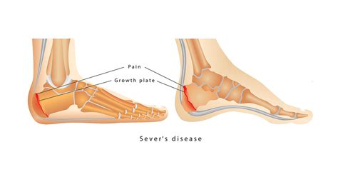 Severs Disease Calcaneal Apophysitis Bodyviva Physiotherapy