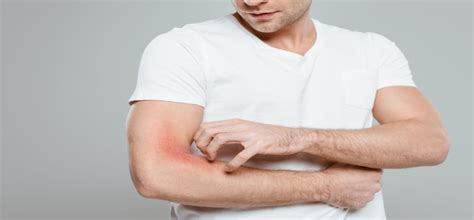 Eczema Short Hills Nj Dermatology Consultants