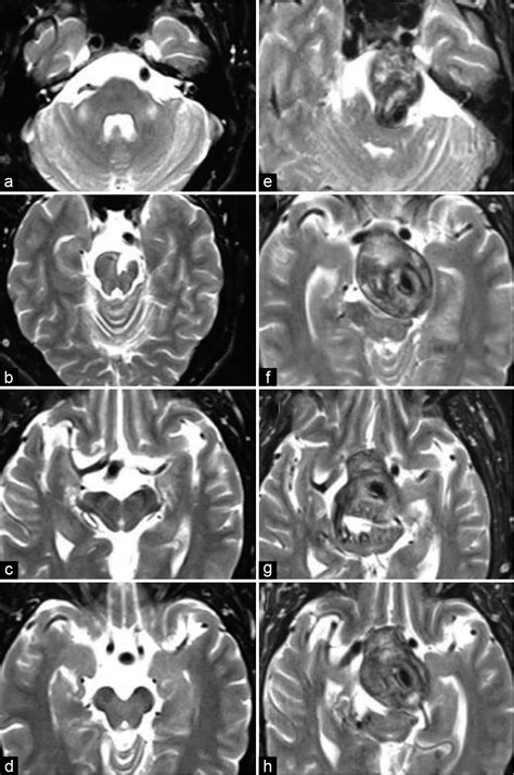 Surgical Neurology International