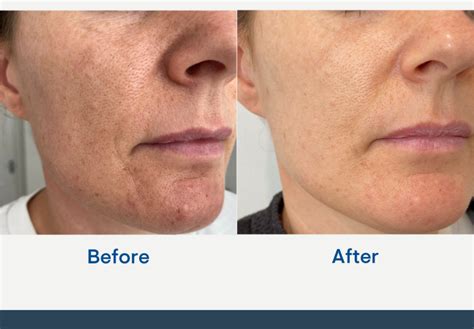 Radiofrequency Microneedling · Rf Microneedling Treatment · Fiji Skin