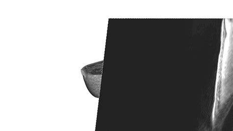 Improving Breast Cancer Detection In Ultrasound Imaging Using Ai Nvidia Technical Blog