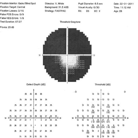 Correlation Between OCT And Visual Fields For The Right OD And Left Download Scientific