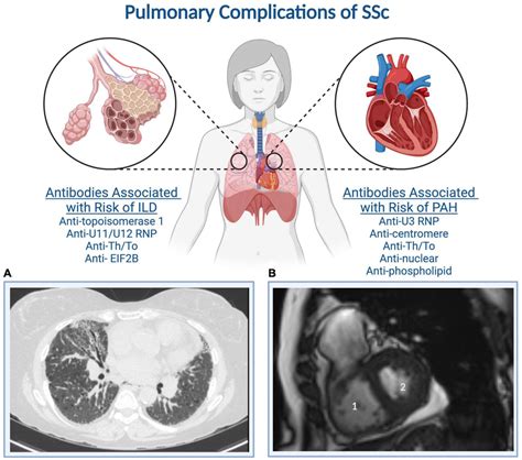 systemic sclerosis auto antibodies associated with the development of