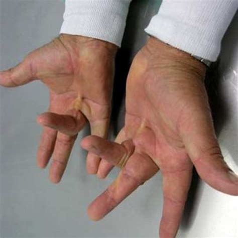 Pdf Partial Fasciectomy For Dupuytrens Contractures