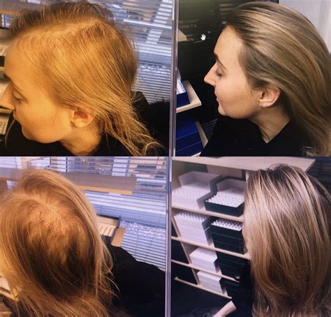 Female Hair Loss Treatment Photos The Hair Loss Centre