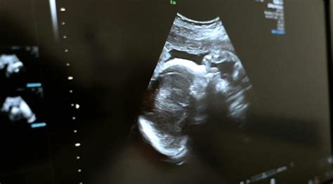 Sry Gene In Females Challenges Sex Determination Theory