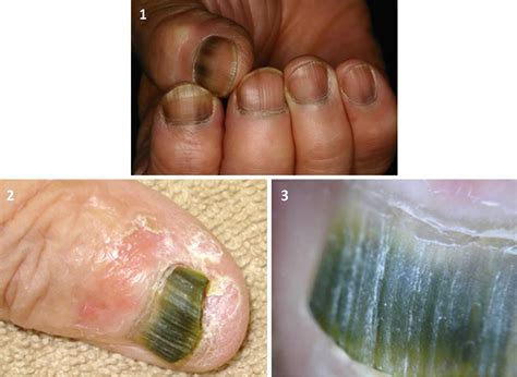 Acral Lentiginous Melanoma Causes Symptoms Treatment And Survival Rate