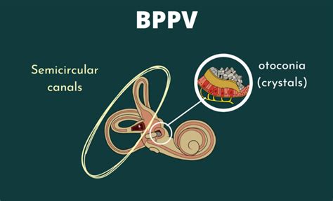 3 Helpful Bppv Treatment Exercises To Do At Home And How To Do Them The Vertigo Doctor