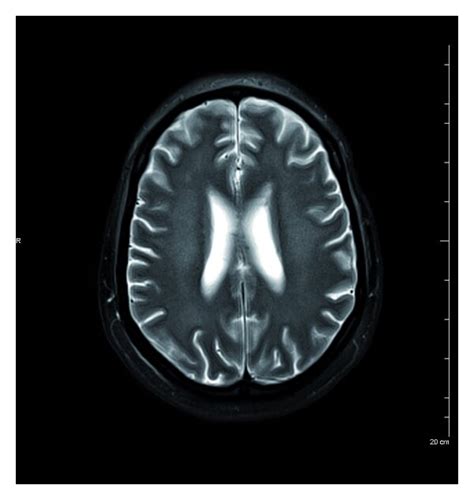 A Dwi Diffusion Weighted Images Bilateral And Symmetric Diffusion