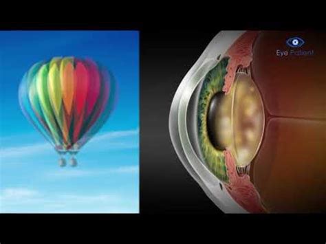 Cataract Concepts Eye Patient