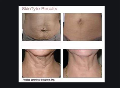 Skin Tightening And Tissue Lifting Edmonds Wa George Delaney Md