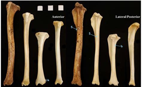 A Tibia Anterior And Posterior Views
