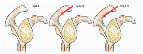 Tendinitis Bursitis Subacromial Impingement Musculoskeletal Key