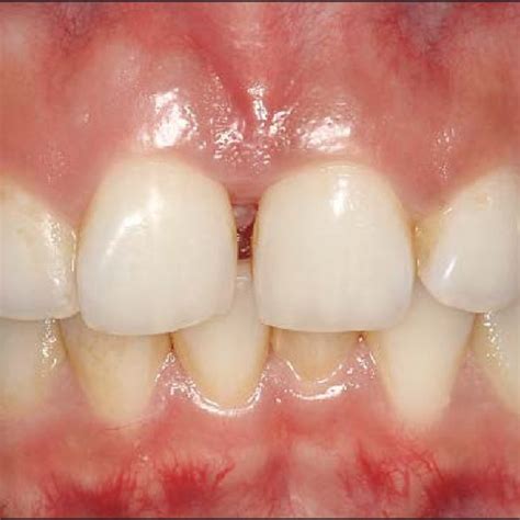 Pdf Prevalence Of Maxillary Midline Papillae Recession And