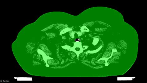Loading Dicom Ctrt Structure Is Incomplete Support 3d Slicer Community