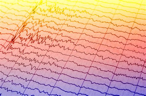 Doctors Detail Unexpected Recoveries From Long Term Coma After Cardiac Arrest Newsroom Weill