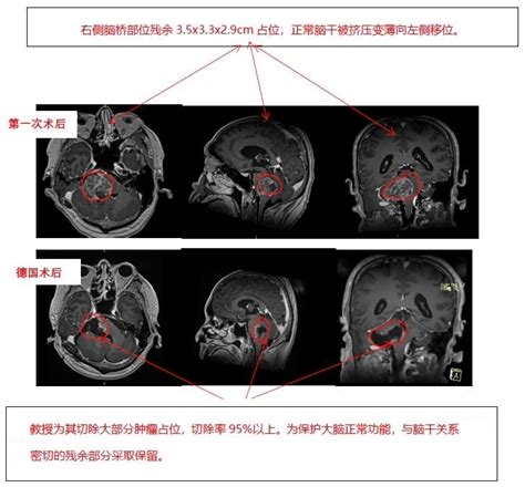 脑干胶质瘤早期表现有哪些脑干胶质瘤化疗有用吗 脑干胶质瘤 化疗 肿瘤 患者 德国 病人 健康界