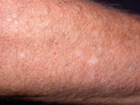 White Sun Spots On Skin Cause Significance Treatment