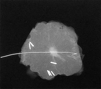 What Is A Lumpectomy My Breast My Health