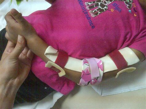 Chapter 4 Arthrogryposis Appi America