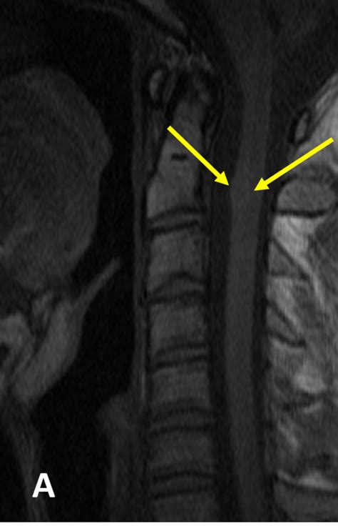 Cavernous Malformation Cm Of The Spine Mri Online Medality