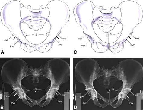 The Ischial Spine Sign Does Pelvic Tilt And Rotation Matter Pmc