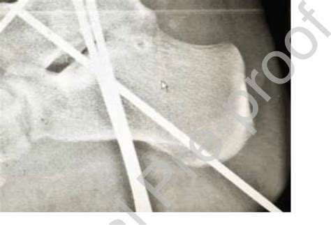 Operative Reduction And Pnning Of The Total Talar Dislocation Download Scientific Diagram