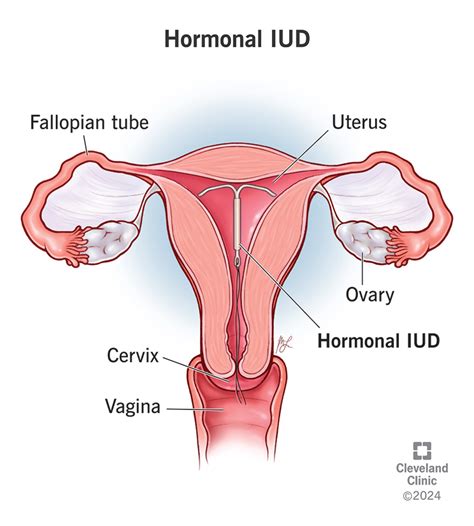 Mirena Intrauterine Device Iud Advanced Contraception Methods