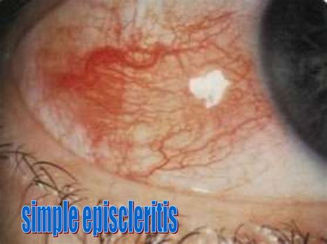 Episcleritis And Scleritis