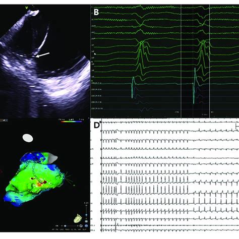 A Large Inferoseptal Ventricular Septal Defect As Seen On Echocardiography Download