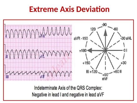 Lecture On Cardiac Axis On Ecg For Nurses Ppt