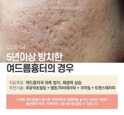천안여드름흉터 한의원 박스카형흉터는 치료가 안 된다 네이버 포스트