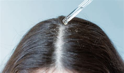 Scalp Conditions Family Health Diary