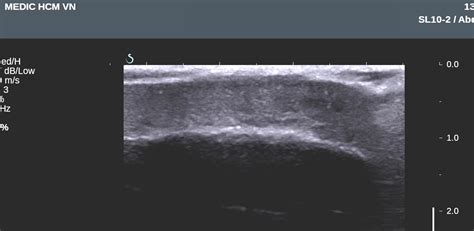 Vietnamese Medic Ultrasound Case 353 Scalp Skin Tumor Dr Phan Thanh HẢi Dr LÊ ThÔng LƯu