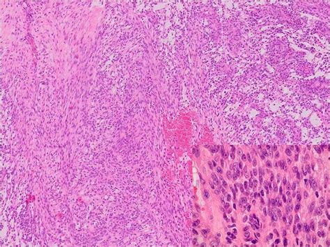Monomorphic Epithelioid And Spindle Shaped Cells In A Cellular Emc