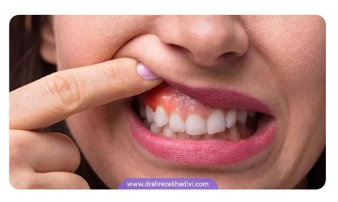 عفونت لثه؛ علائم و روش های درمان عفونت لثه