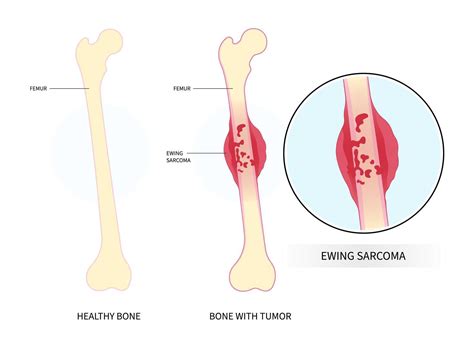 Ewing Sarcoma Creative Diagnostics
