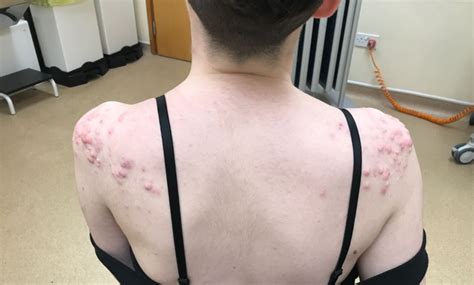 Keloid Acne Vulgaris Why Im Done Hiding My Skin Condition Huffpost