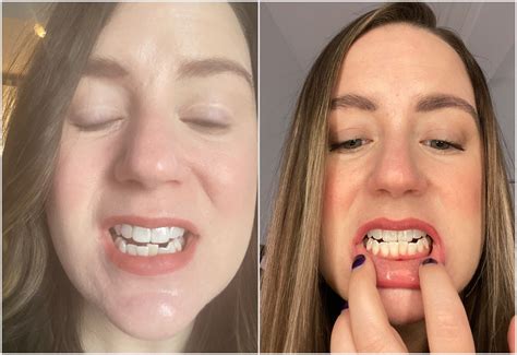 Smile Direct Club Teeth Aligners Review And Photos Popsugar Beauty