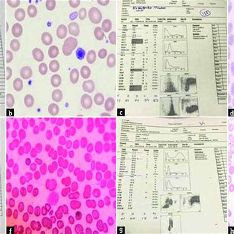 Comparison Of Platelet Detection By Automated Hematology Analyzer And Download Scientific