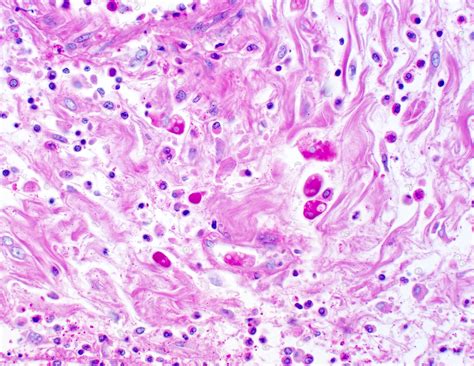 Endoscopic Findings Of Amebic Colitis At Alberto Vargas Blog