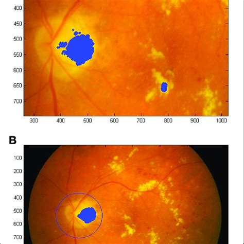 Dot Hemorrhage Segmentation From The Fundus Image Download Scientific Diagram