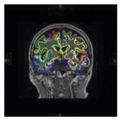 Cross Sectional Segmentation Results For T1 Weighted Mri Images A